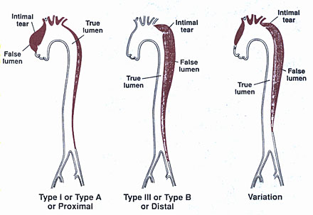 Artist's depiction of the three major anatomic patterns of aortic ...
