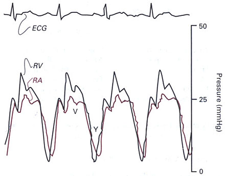 Tricuspid regurgitation